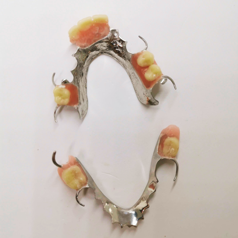 Chrome Cobalt Denture – Nexus Denture Lab Services