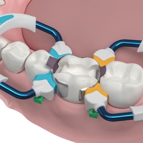 Strata-G™ Sentional Matrix System – SENKA Dental Supply