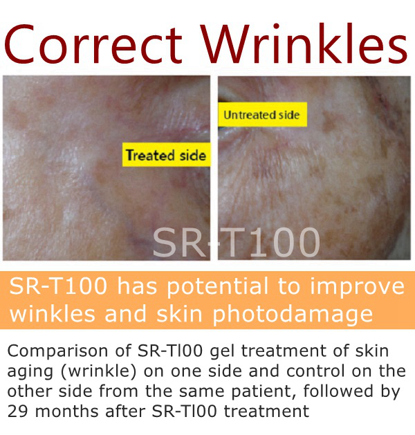 The Best Treatment For Actinic Keratosis Solar Keratoses Actinic